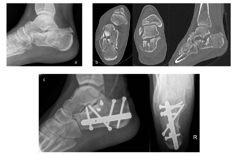 C-NAIL in Journal of Orthopaedic Surgery and Research